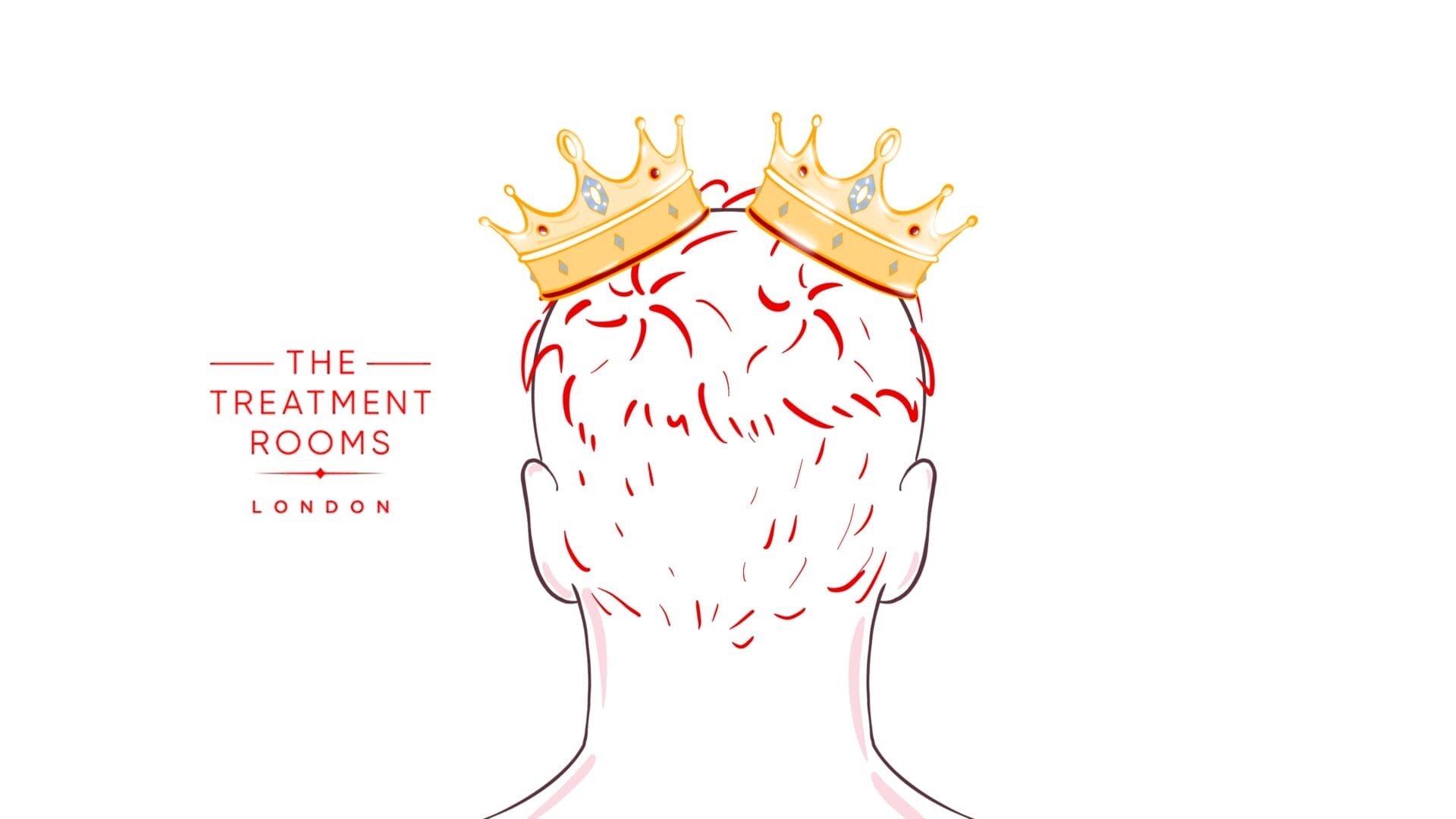 What are Double Crowns? | Treatment Rooms London