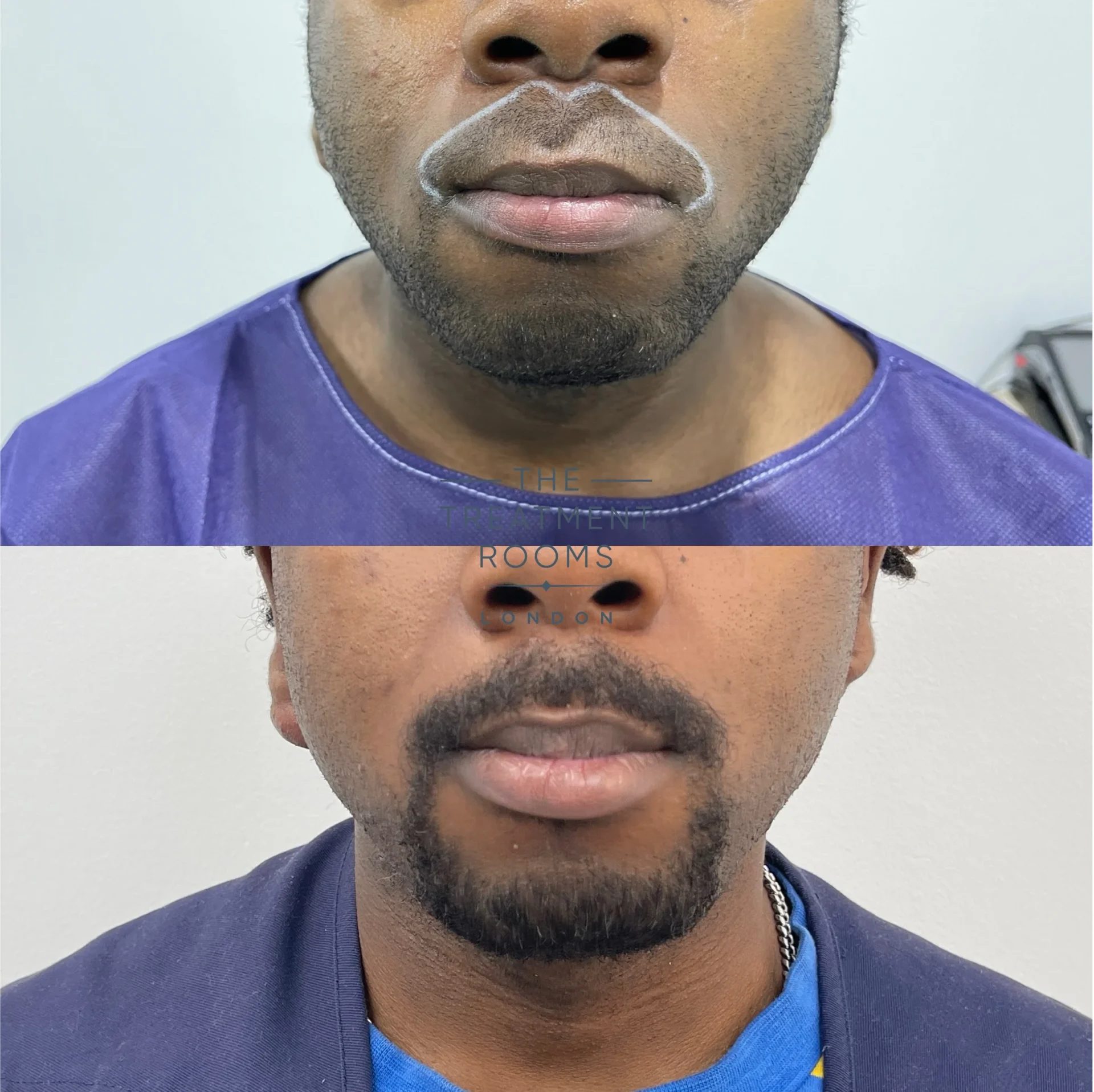 Beard Transplant Surgery Facial Hair Transplant