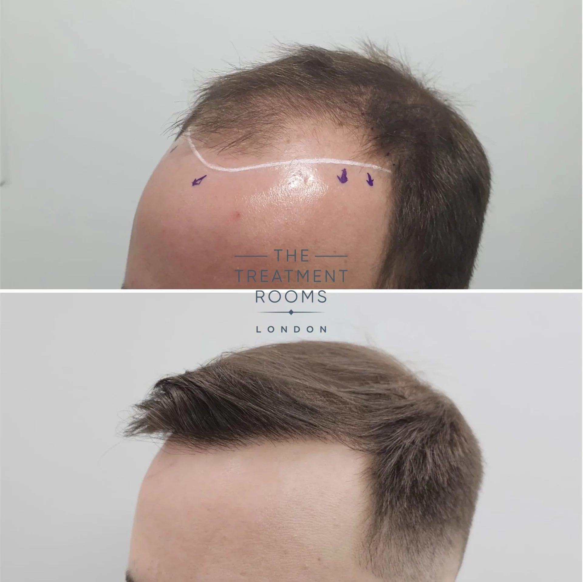 Fue Hair Transplant Result 2187 Grafts Treatment Rooms London