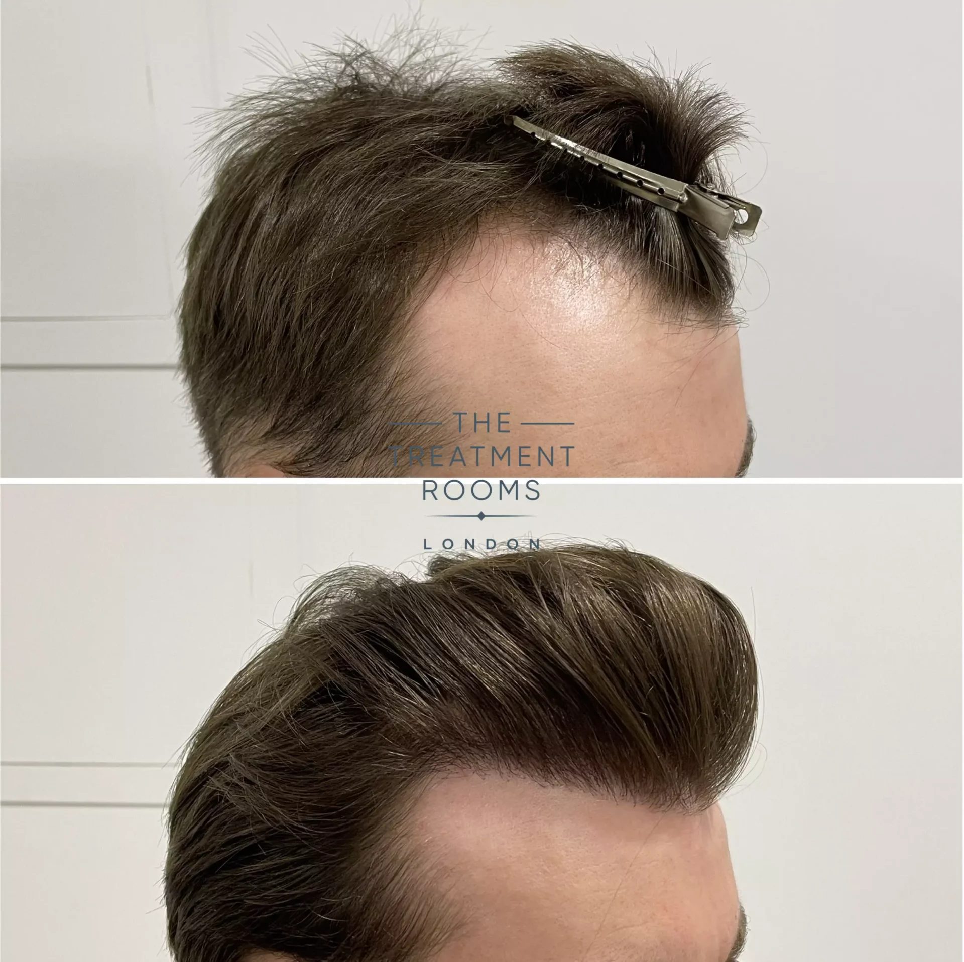 Fue Hair Transplant 1357 Grafts Treatment Rooms London