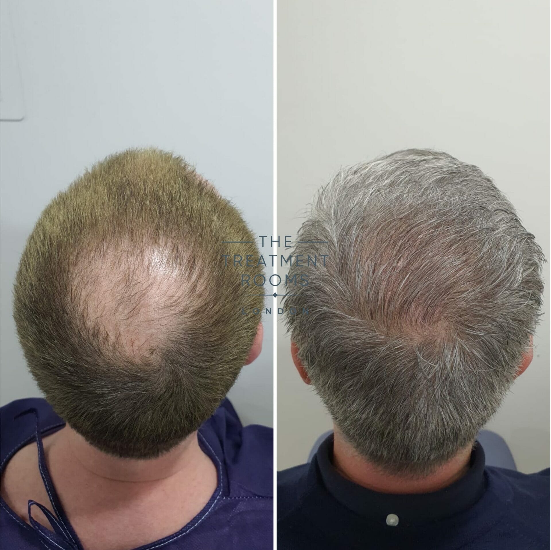 Balding Crown & Crown Hair Transplant | Treatment Rooms London