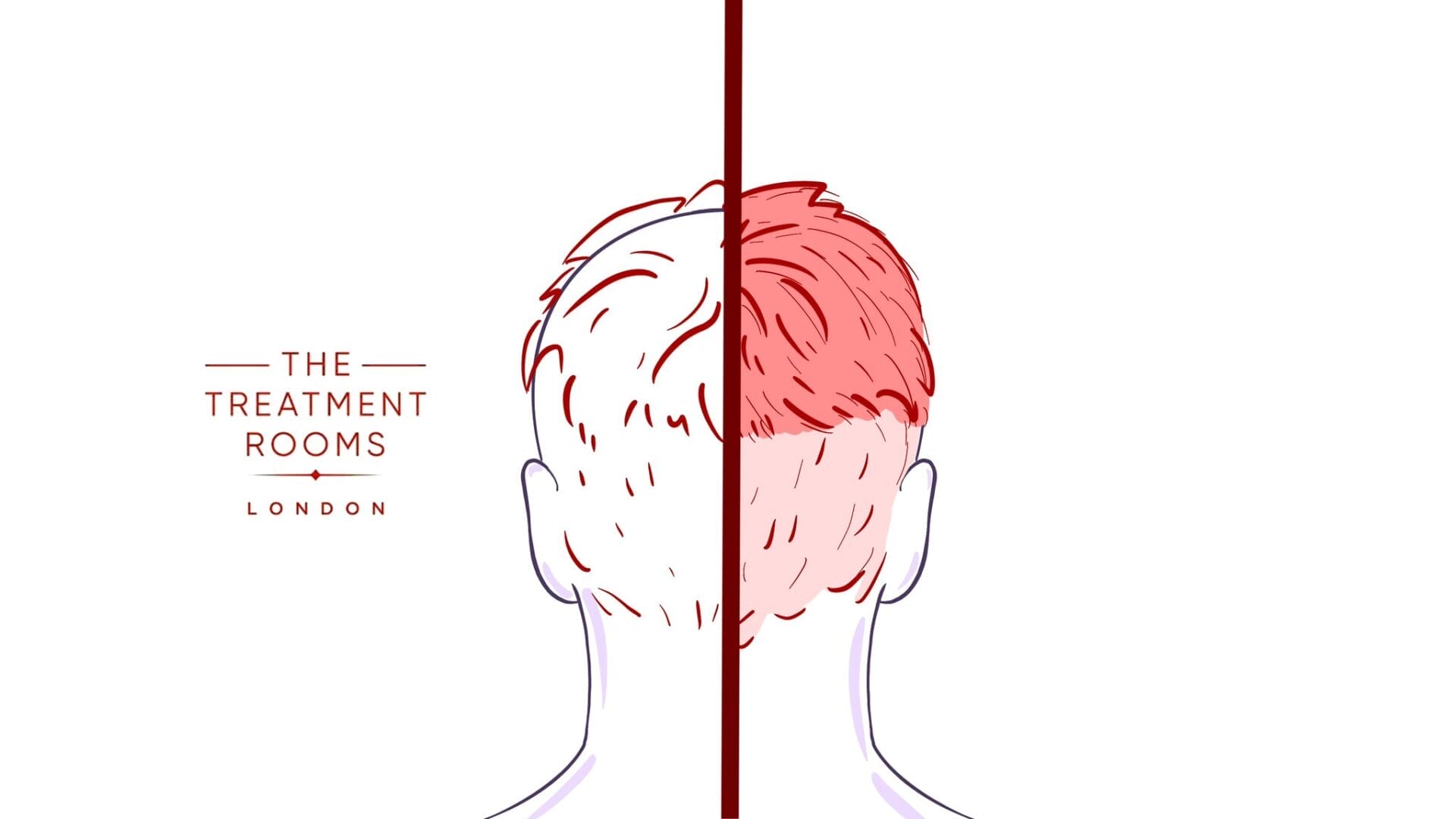 One-Sided Hair Loss Treatments | Treatment Rooms London